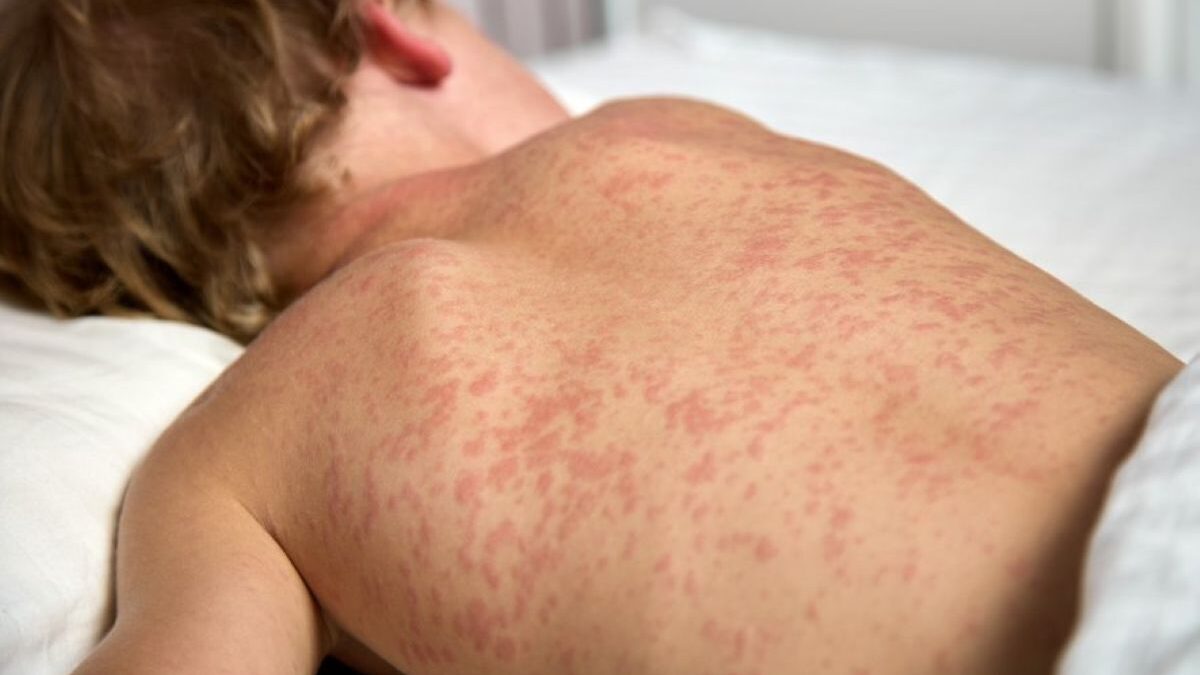 Alerte en France sur la recrudescence de la rougeole en provenance du Maroc